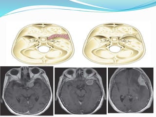 Clinoidal meningioma | PPTX