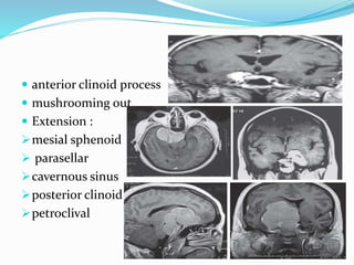 Clinoidal meningioma | PPTX