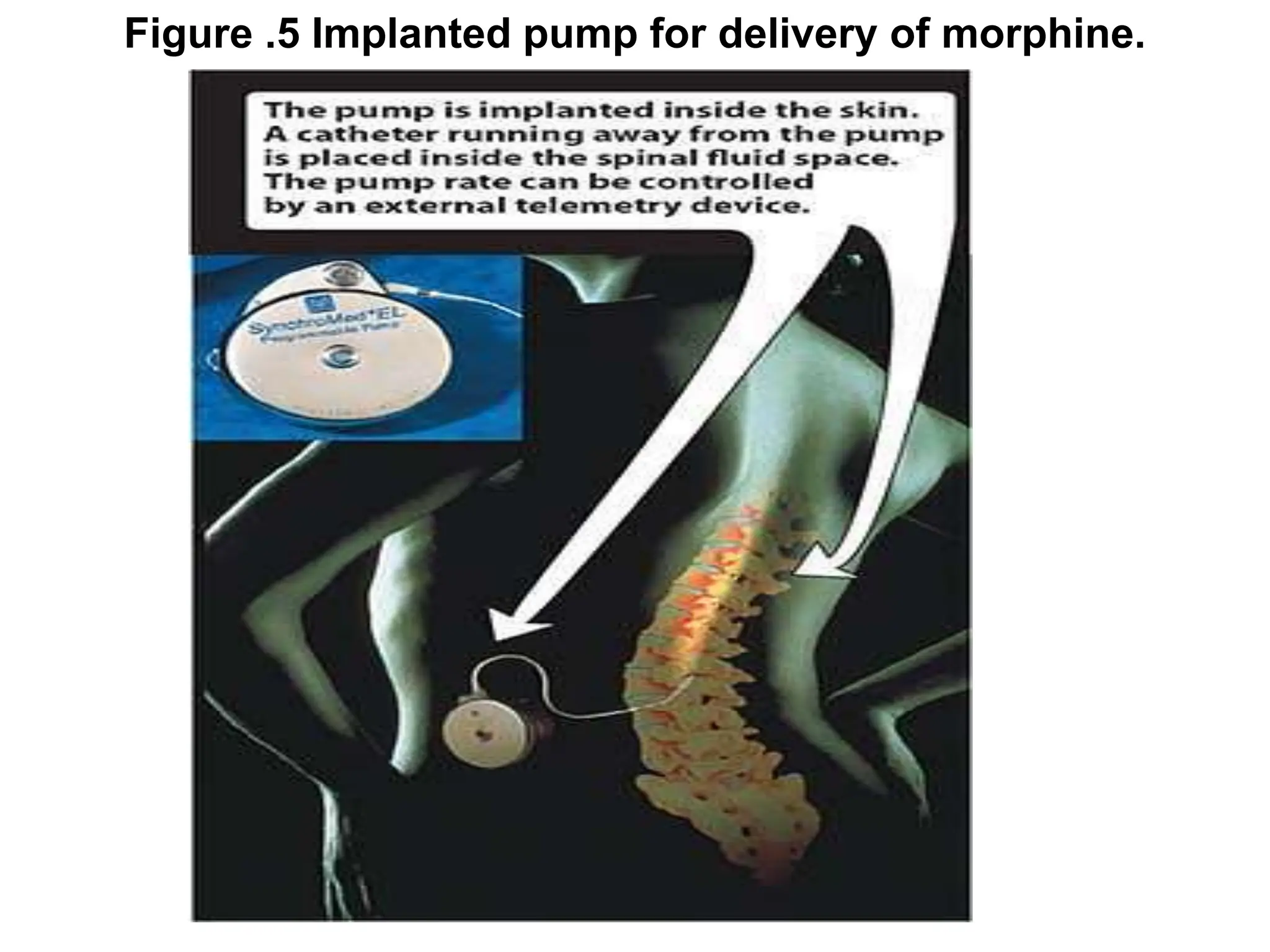 clinical pharmacology of opioid analgesics .ppt