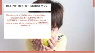 Clin Pres of Marasmus.pptx