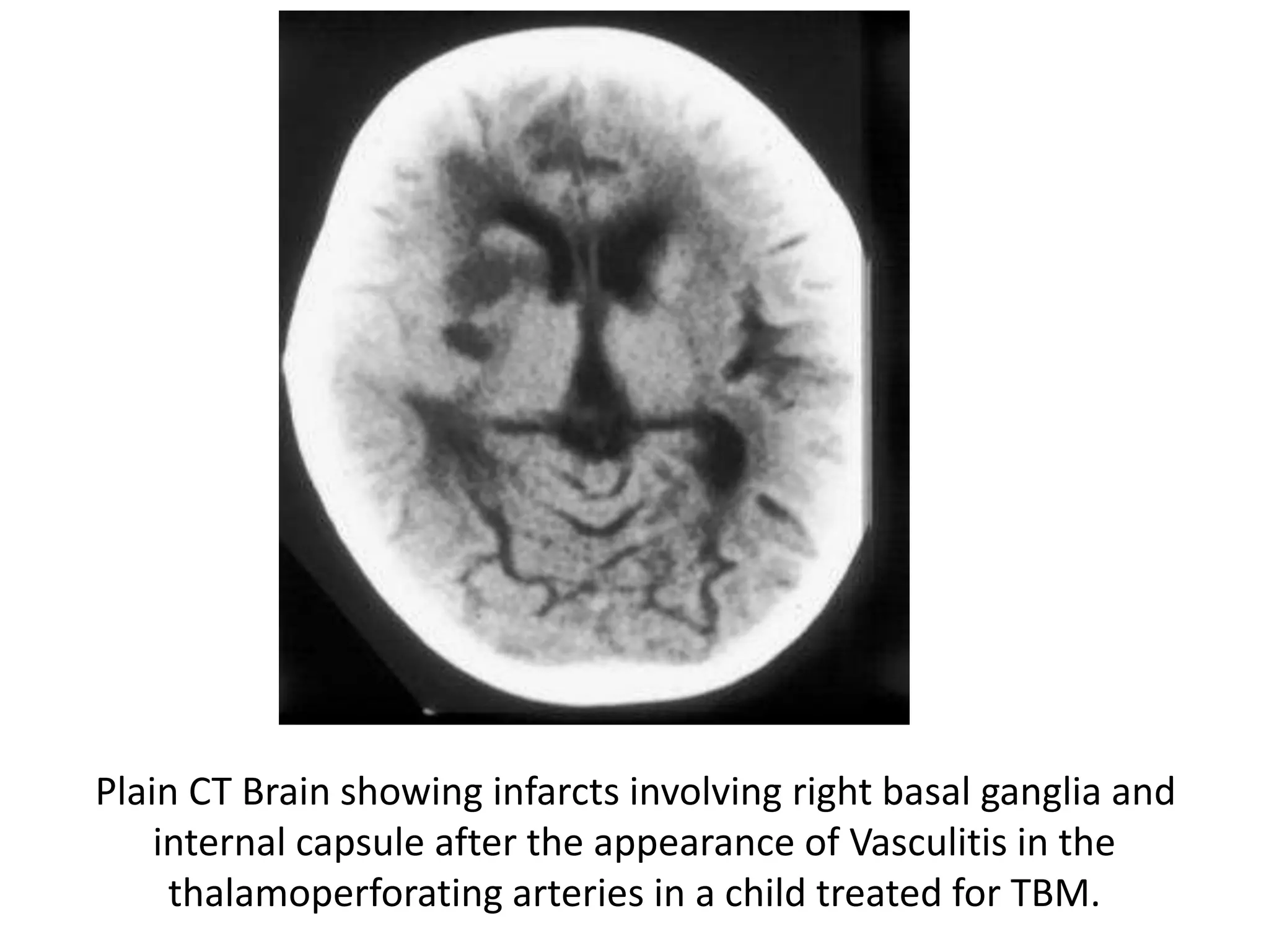 CLINICAL RADIOLOGY CEREBRAL TUBERCULOSIS | PPTX