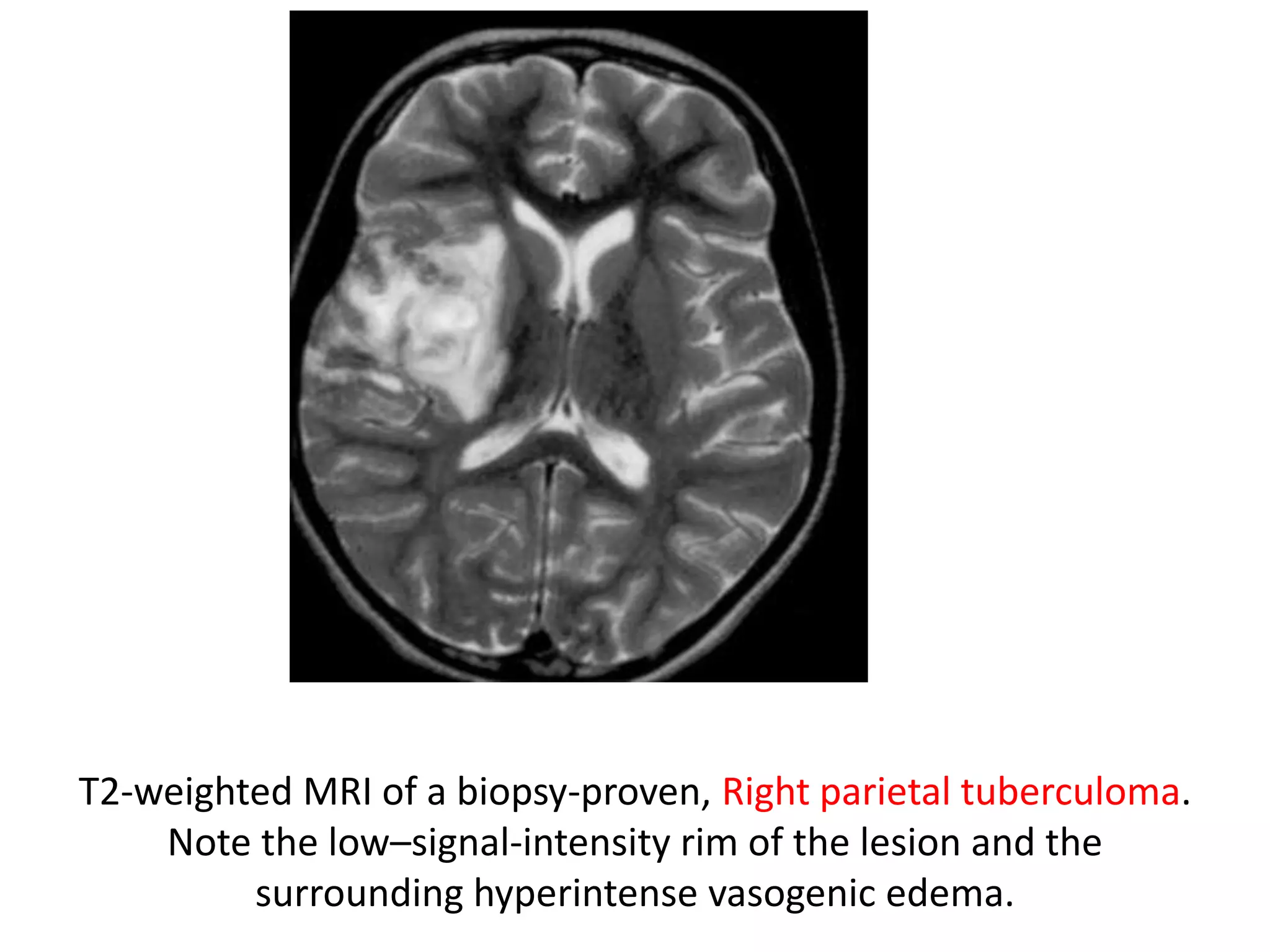 CLINICAL RADIOLOGY CEREBRAL TUBERCULOSIS | PPTX