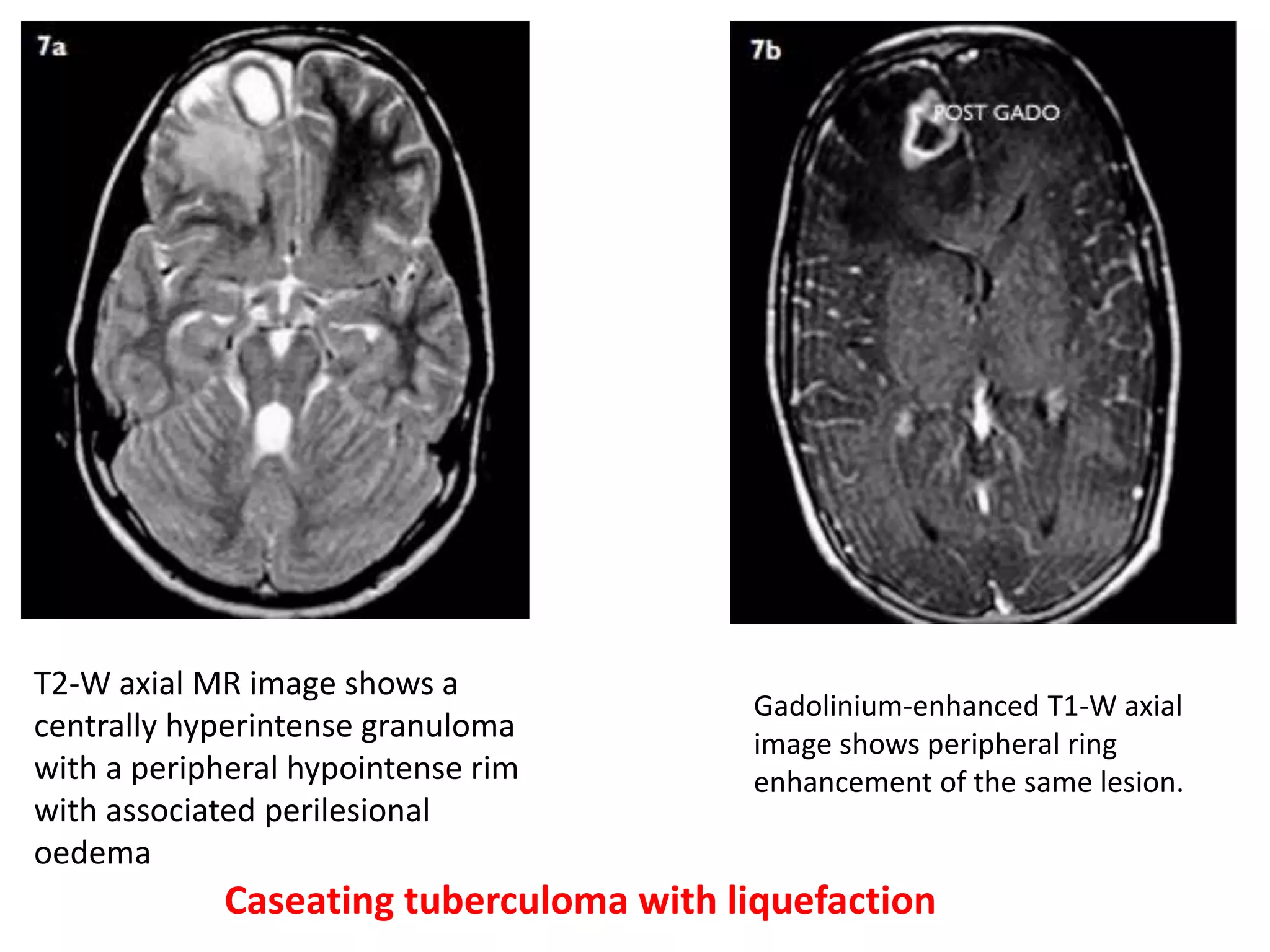 CLINICAL RADIOLOGY CEREBRAL TUBERCULOSIS | PPTX