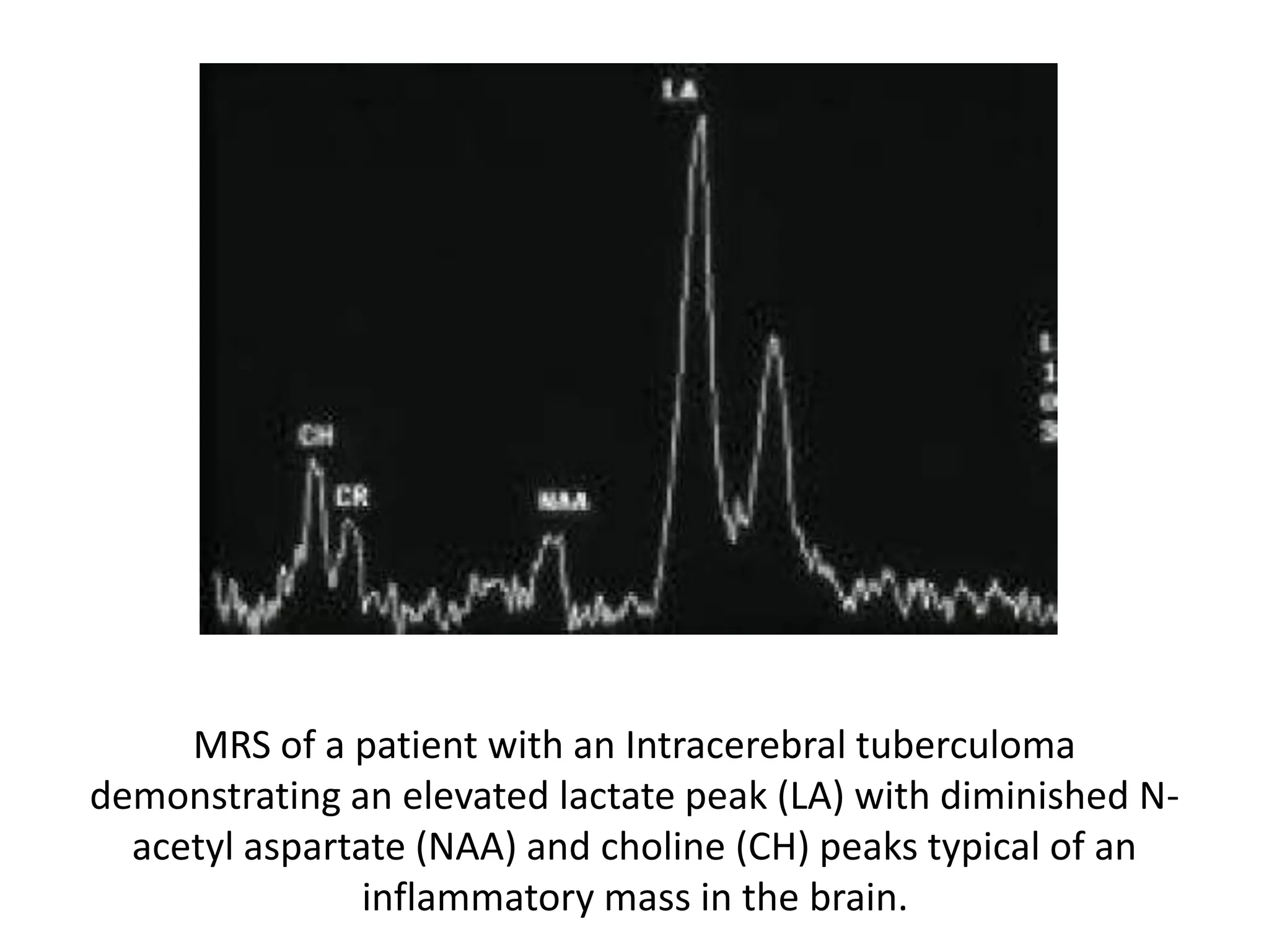 CLINICAL RADIOLOGY CEREBRAL TUBERCULOSIS | PPTX