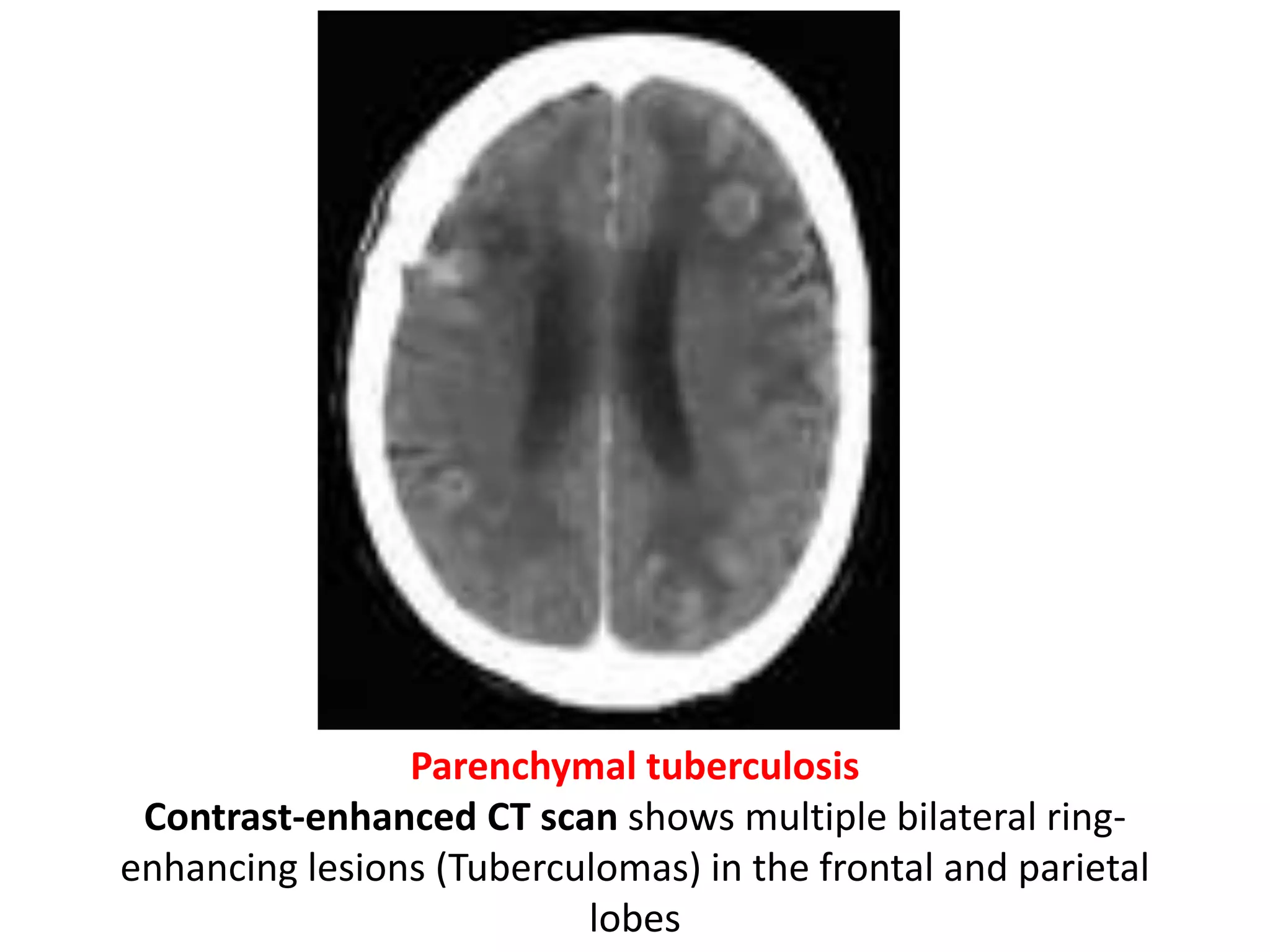 CLINICAL RADIOLOGY CEREBRAL TUBERCULOSIS | PPTX