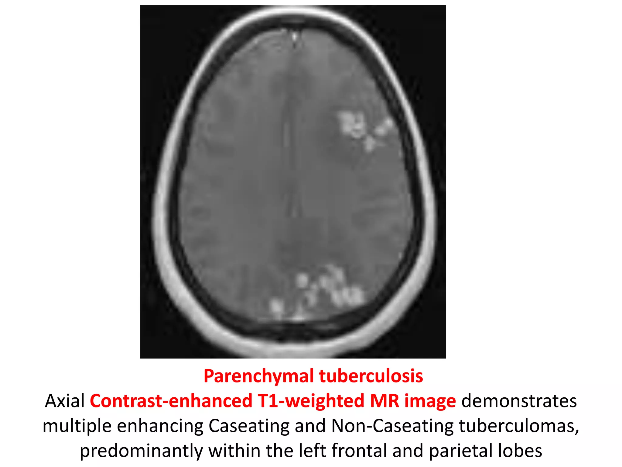 CLINICAL RADIOLOGY CEREBRAL TUBERCULOSIS | PPTX