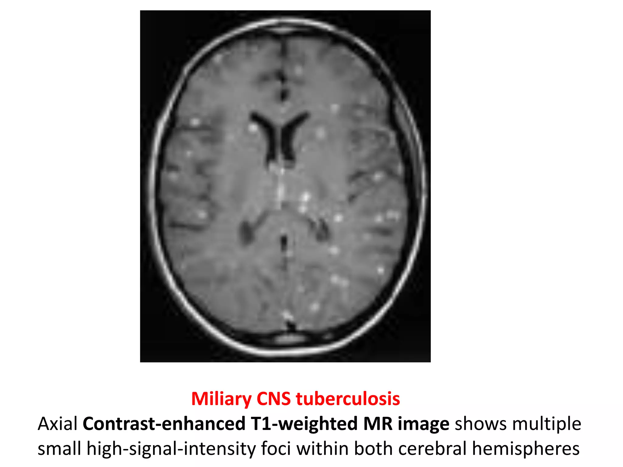 CLINICAL RADIOLOGY CEREBRAL TUBERCULOSIS | PPTX