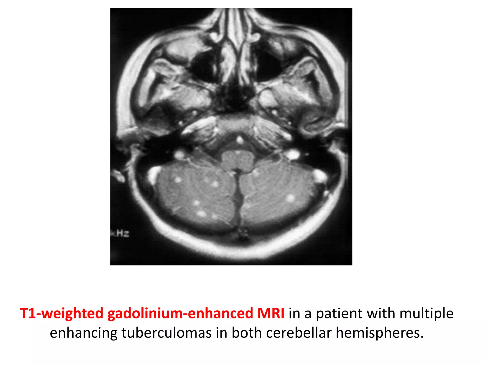 CLINICAL RADIOLOGY CEREBRAL TUBERCULOSIS | PPTX