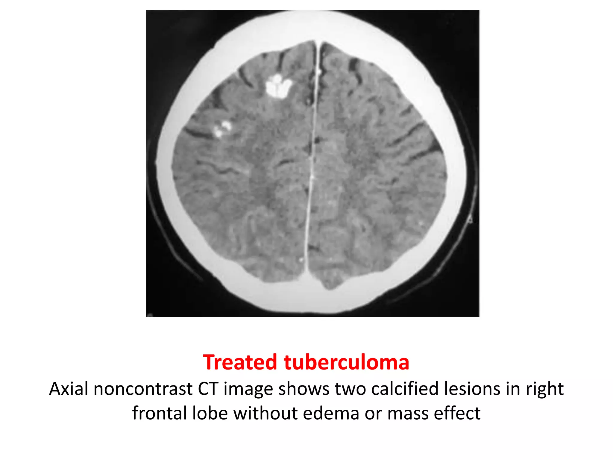 CLINICAL RADIOLOGY CEREBRAL TUBERCULOSIS | PPTX