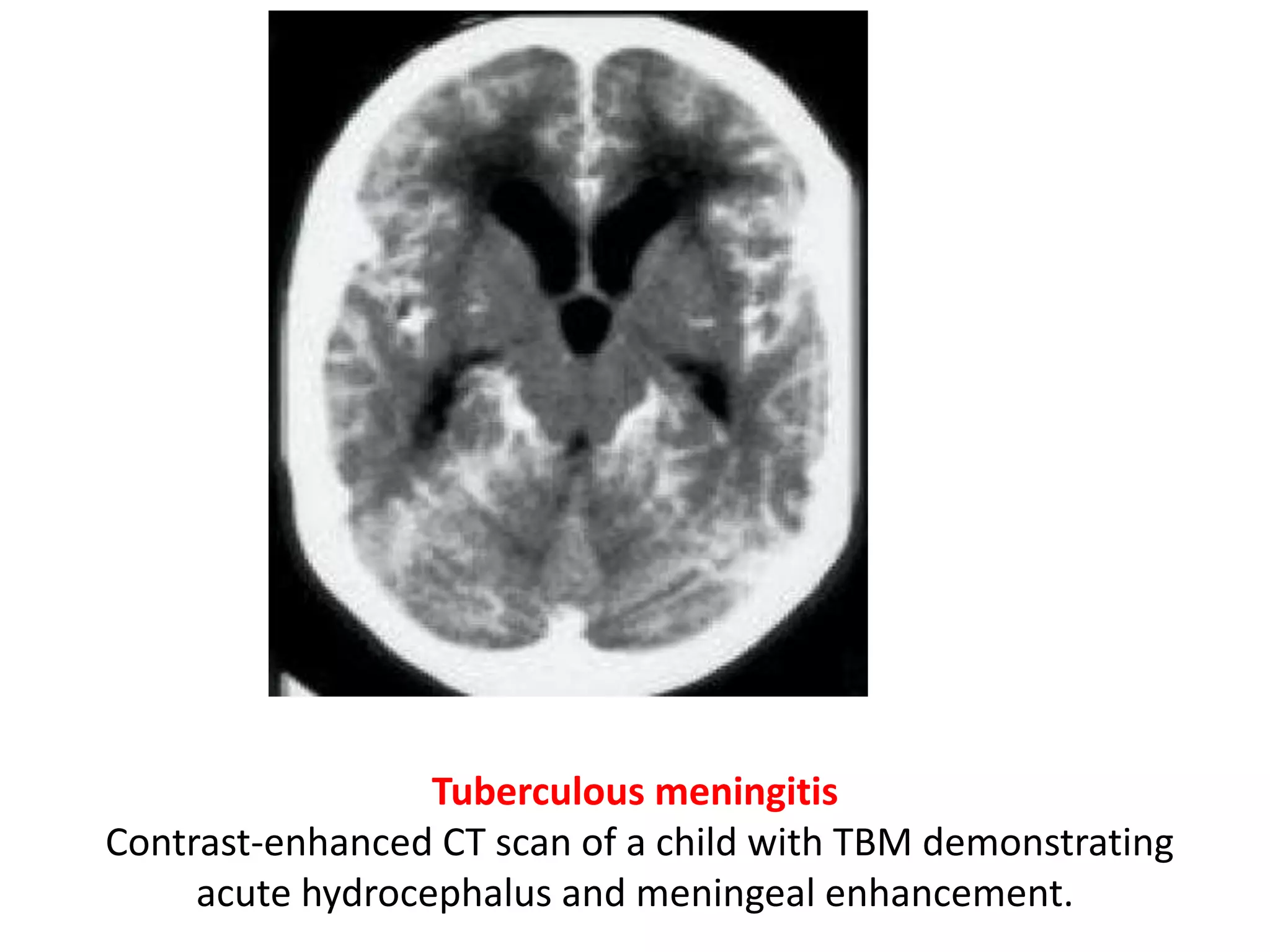 CLINICAL RADIOLOGY CEREBRAL TUBERCULOSIS | PPTX