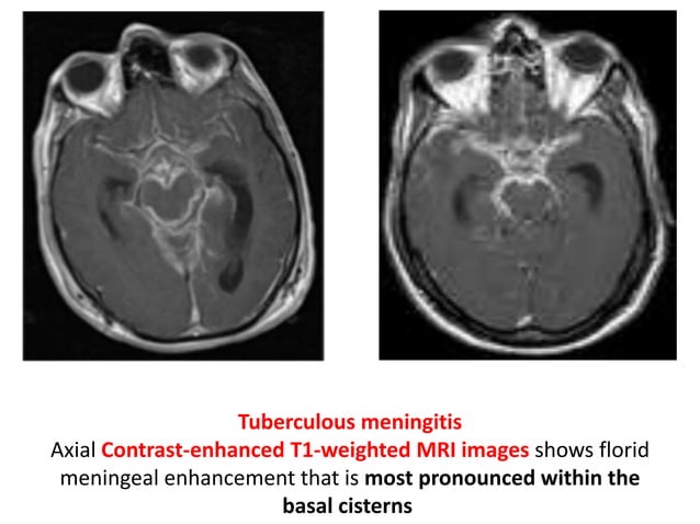 CLINICAL RADIOLOGY CEREBRAL TUBERCULOSIS | PPTX | Brain and Nervous ...