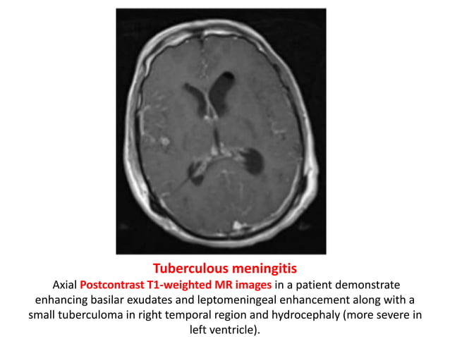 CLINICAL RADIOLOGY CEREBRAL TUBERCULOSIS | PPTX | Brain and Nervous System Disorders | Diseases ...