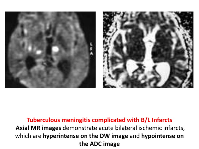 CLINICAL RADIOLOGY CEREBRAL TUBERCULOSIS | PPTX | Brain and Nervous ...