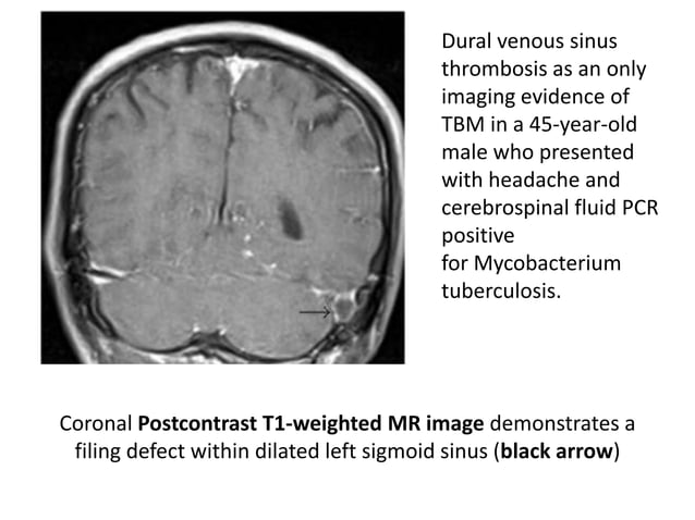 CLINICAL RADIOLOGY CEREBRAL TUBERCULOSIS | PPTX | Brain and Nervous ...