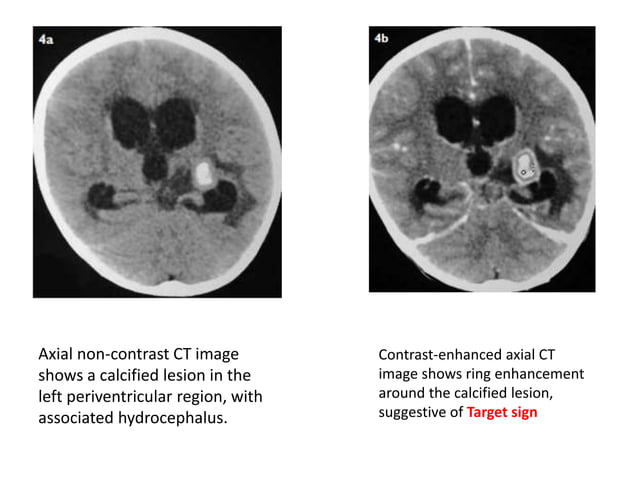 CLINICAL RADIOLOGY CEREBRAL TUBERCULOSIS | PPTX | Brain and Nervous ...