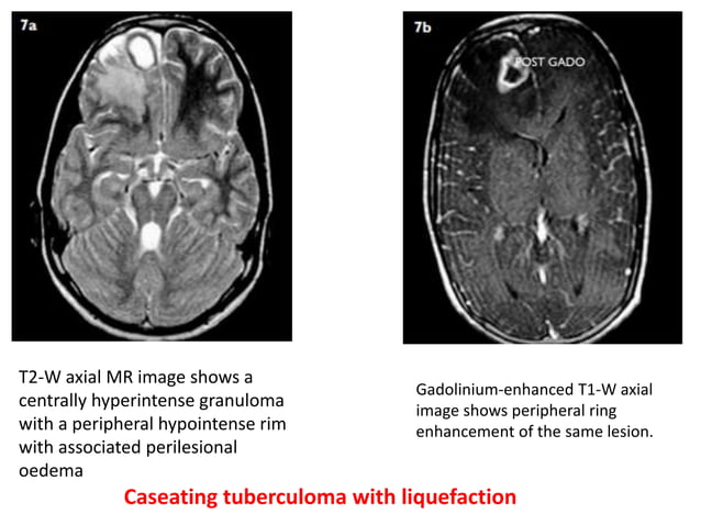 CLINICAL RADIOLOGY CEREBRAL TUBERCULOSIS | PPTX | Brain and Nervous ...