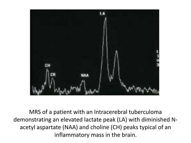 CLINICAL RADIOLOGY CEREBRAL TUBERCULOSIS | PPTX | Brain and Nervous ...