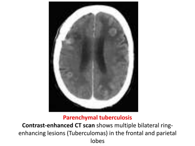 CLINICAL RADIOLOGY CEREBRAL TUBERCULOSIS | PPTX | Brain and Nervous ...