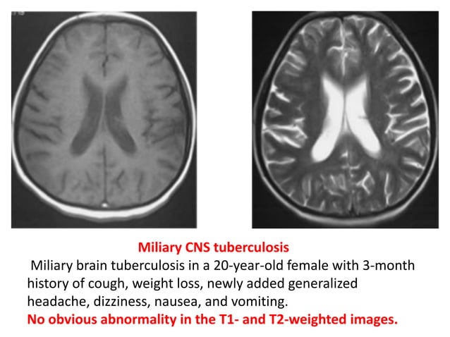 CLINICAL RADIOLOGY CEREBRAL TUBERCULOSIS | PPTX | Brain and Nervous ...