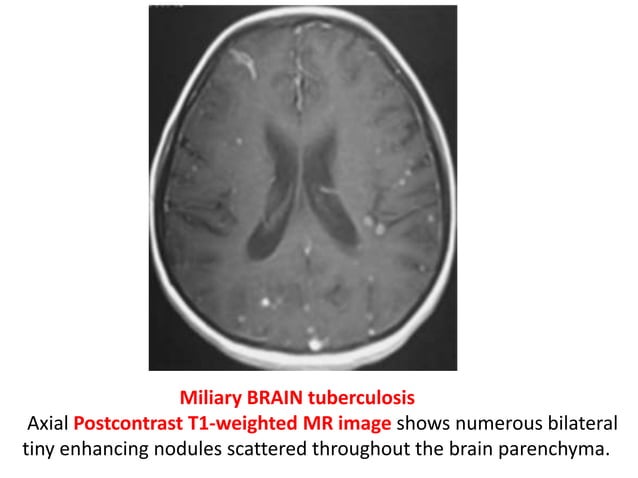 CLINICAL RADIOLOGY CEREBRAL TUBERCULOSIS | PPTX | Brain and Nervous ...