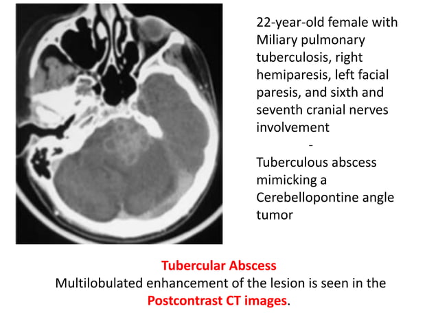 CLINICAL RADIOLOGY CEREBRAL TUBERCULOSIS | PPTX | Brain and Nervous ...