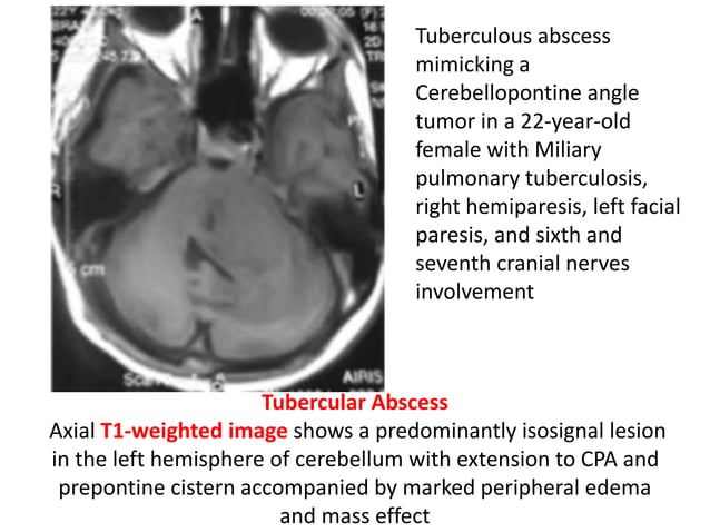 CLINICAL RADIOLOGY CEREBRAL TUBERCULOSIS | PPTX | Brain and Nervous ...