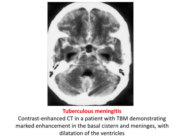 CLINICAL RADIOLOGY CEREBRAL TUBERCULOSIS | PPTX | Brain and Nervous ...