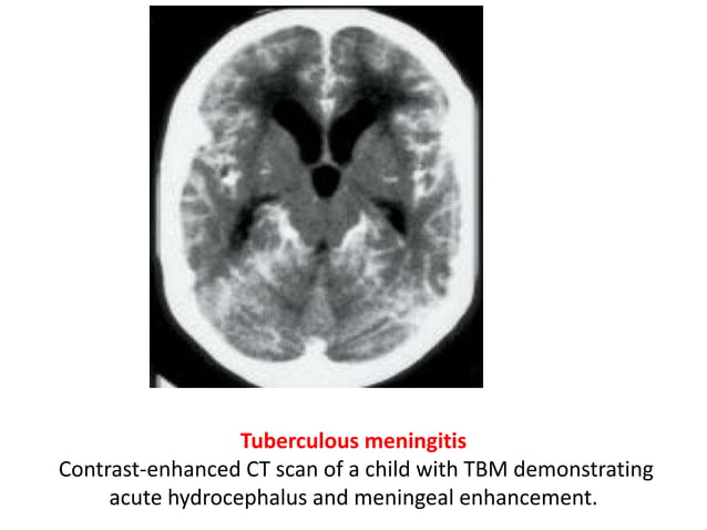 CLINICAL RADIOLOGY CEREBRAL TUBERCULOSIS | PPTX | Brain and Nervous ...