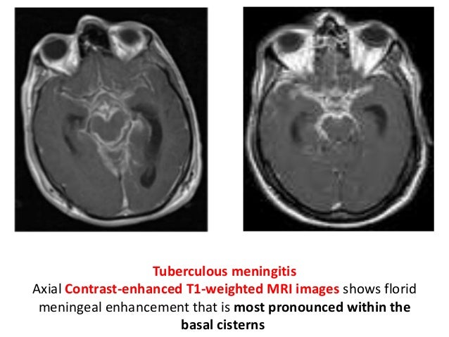 CLINICAL RADIOLOGY CEREBRAL TUBERCULOSIS