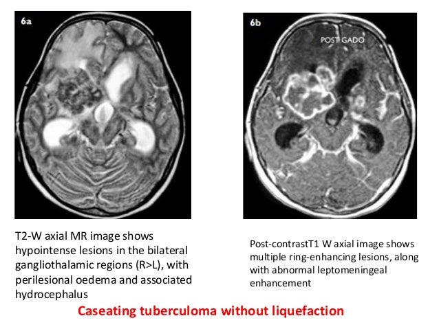 CLINICAL RADIOLOGY CEREBRAL TUBERCULOSIS