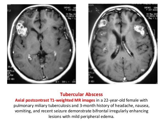 CLINICAL RADIOLOGY CEREBRAL TUBERCULOSIS