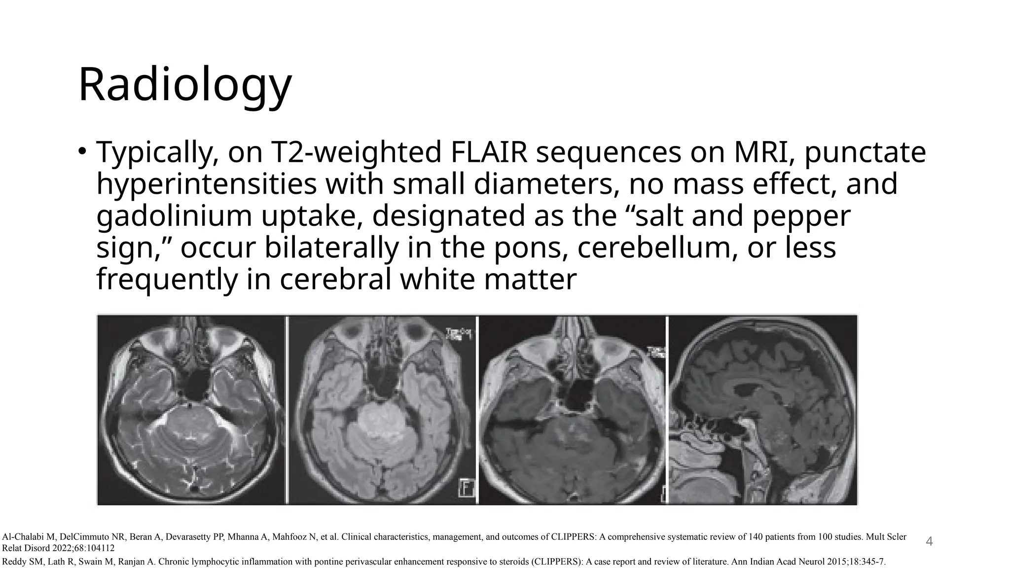 Chronic Lymphocytic Inflammation with Pontine Perivascular Enhancement ...