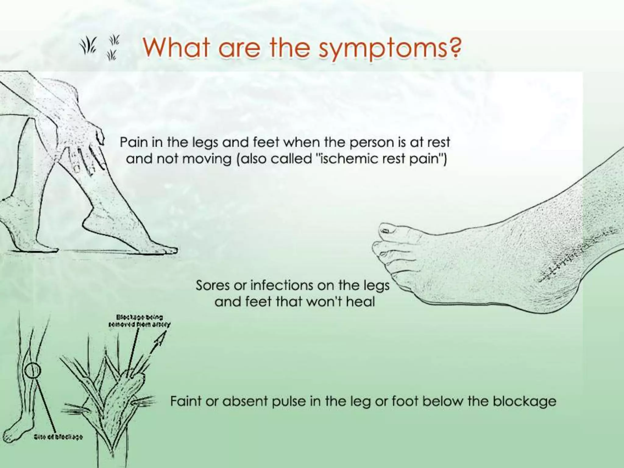Critical Limb Ischemia (CLI) | PPTX