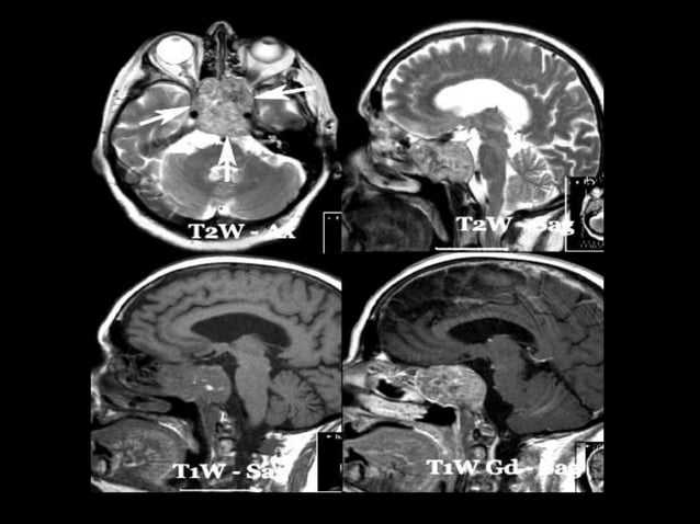 Clival Pathology.ppt