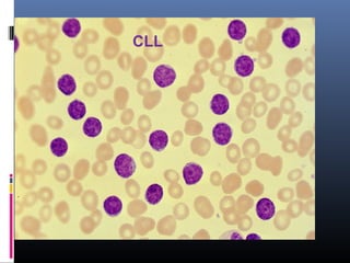 CLL | PPT