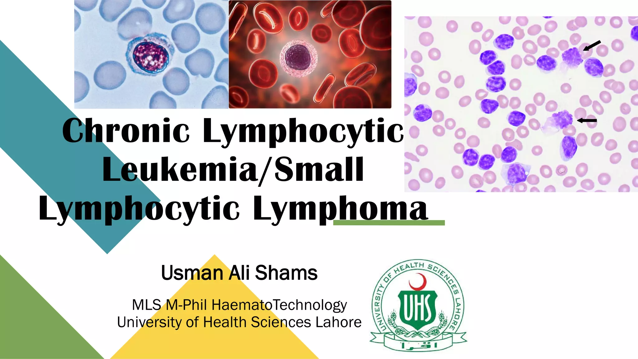 Chronic Lypmhocytic leukemia/SLL/B-PLL/T-PLL/ATLL By SOLOMON SUasb by | PDF