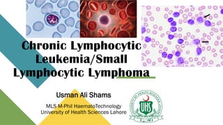 Chronic Lypmhocytic leukemia/SLL/B-PLL/T-PLL/ATLL By SOLOMON SUasb by | PPT