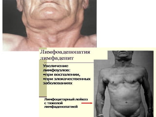 CHRONIC LYMPOCYTIC LUKEMIA HEMATOLOGY.pptx