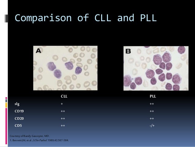 Chronic Lymphocytic Leukemia