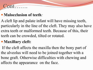 cleft lip and palate | PPTX