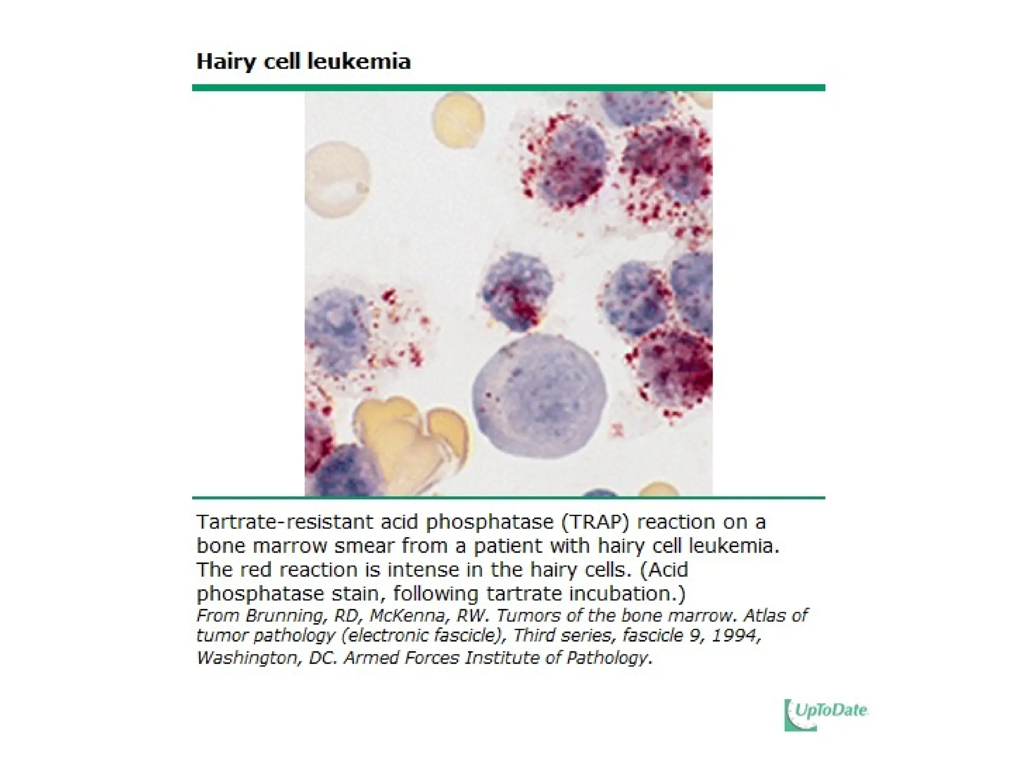 Chronic lymphocytic leukemia (CLL) in blood) | PPT