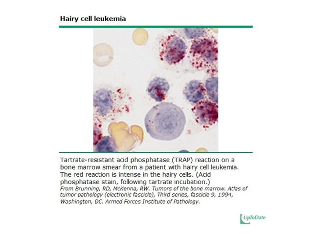 Chronic lymphocytic leukemia (CLL) in blood) | PPT