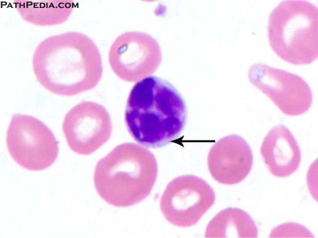 Chronic lymphocytic leukemia