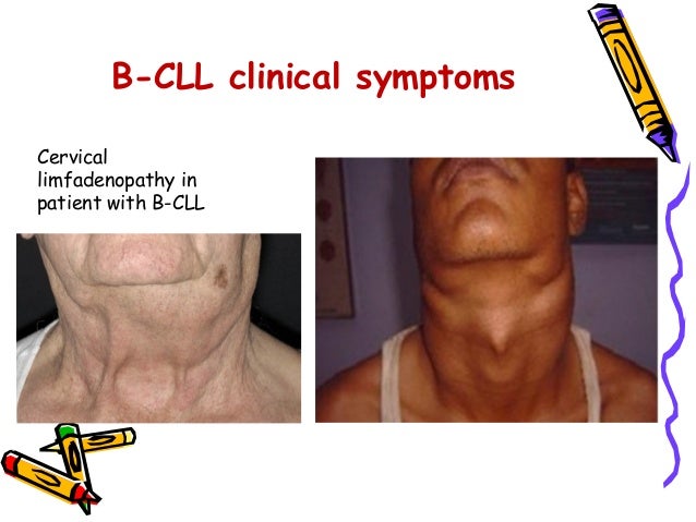 Chronic lymphocytic leukemia