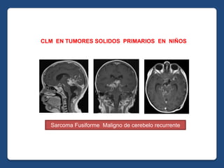 Carcinomatosis Leptomeningea | PPTX