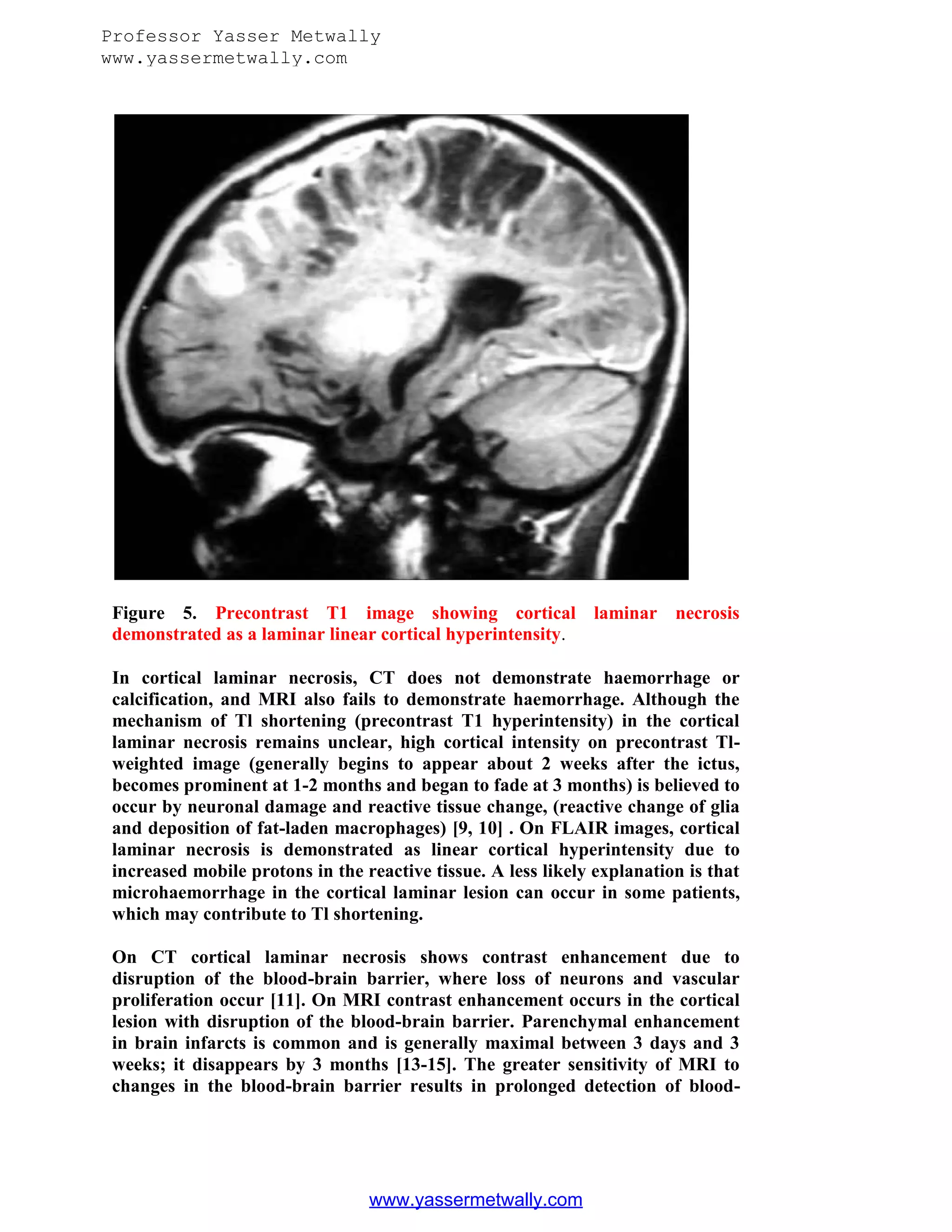 Radiological pathology of cortical laminar necrosis | PDF