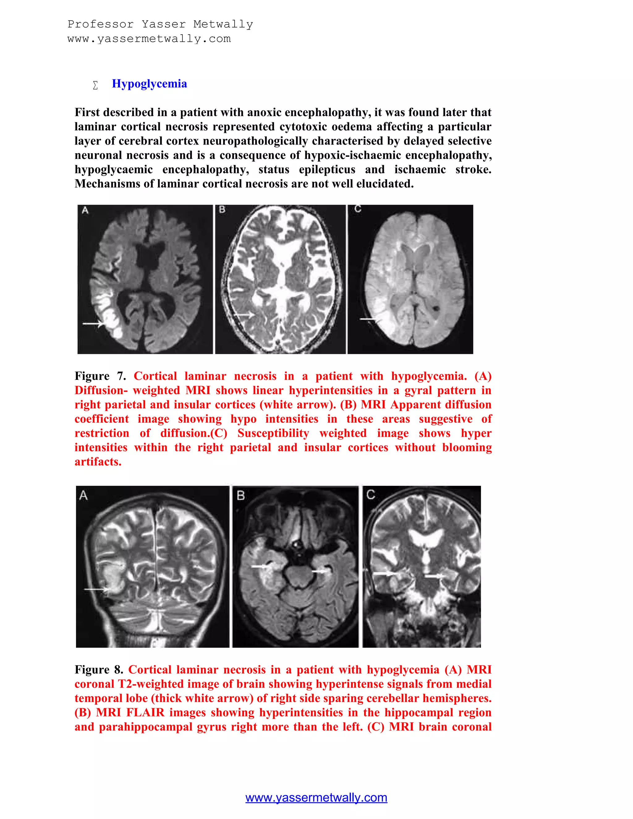 Radiological pathology of cortical laminar necrosis | PDF