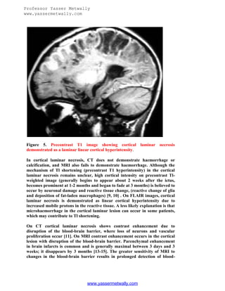 Radiological pathology of cortical laminar necrosis | PDF