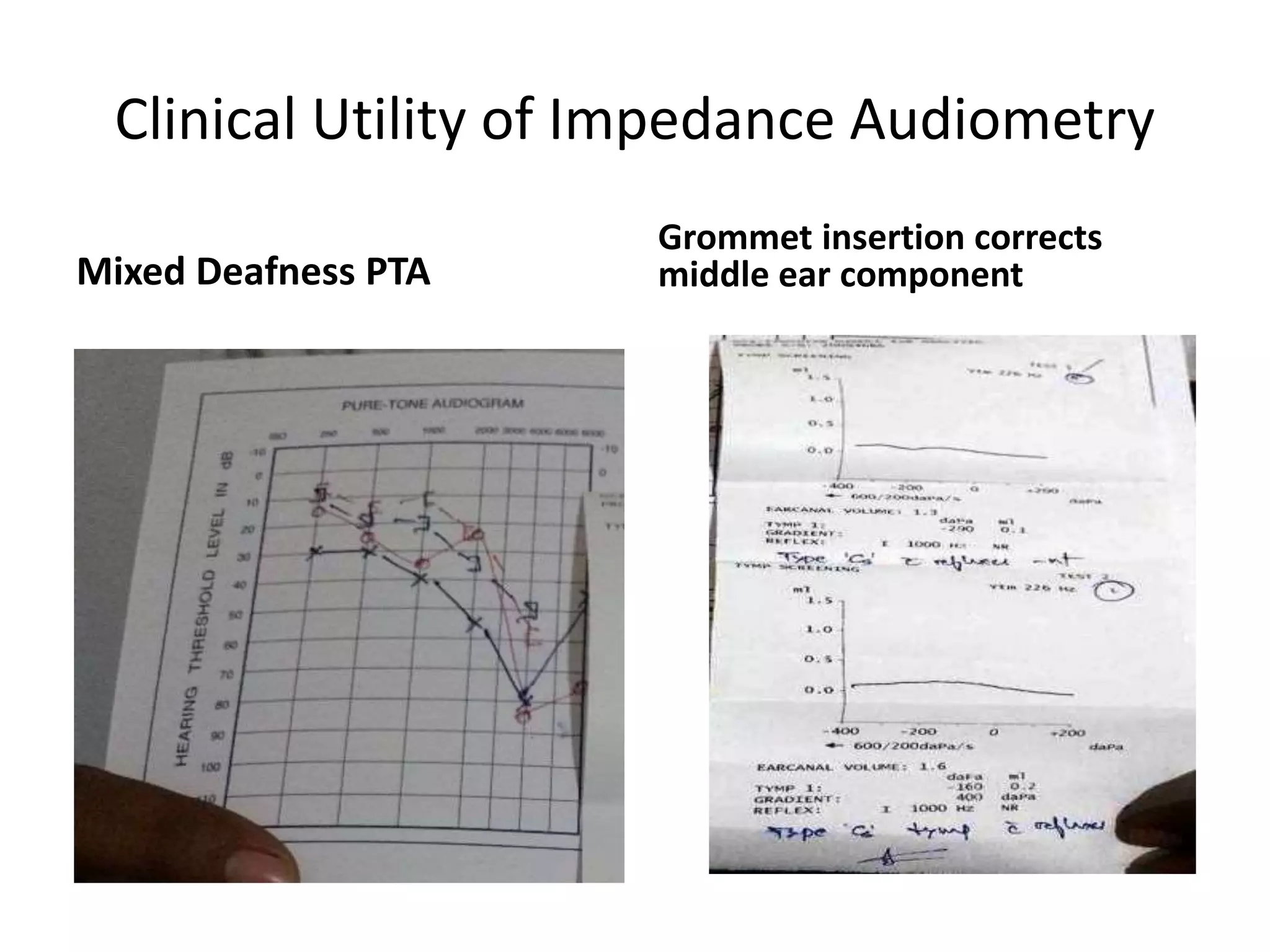 Clncal utility of impedance audiometry | PPTX | Ear, Nose and Throat ...