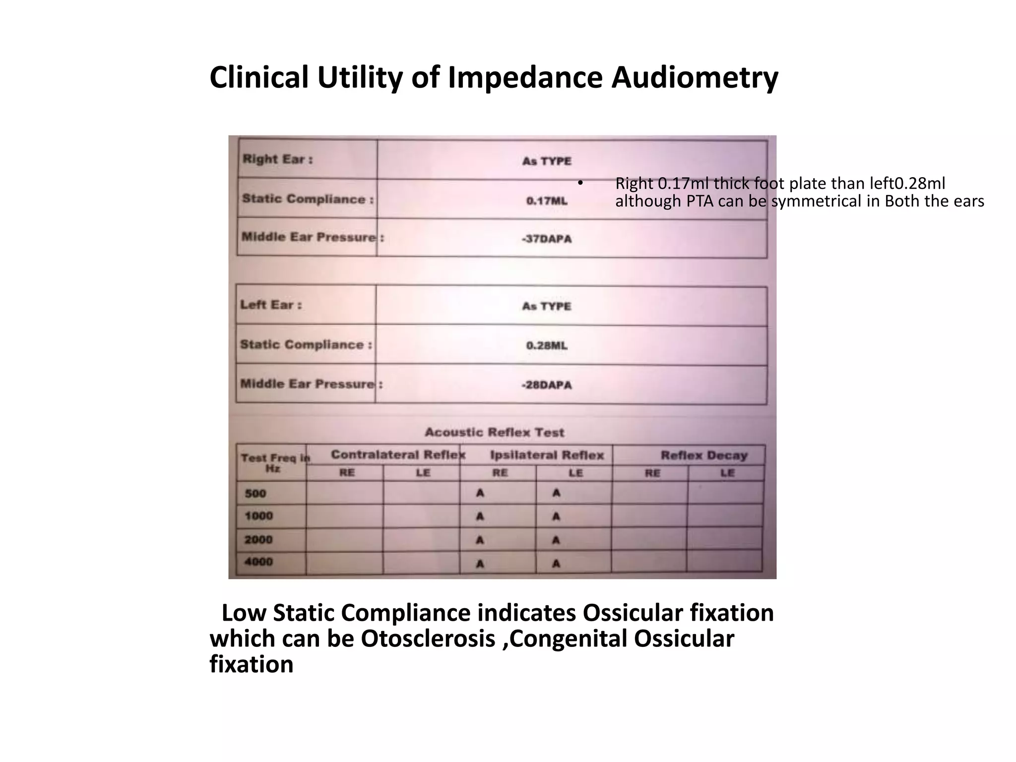 Clncal utility of impedance audiometry | PPTX | Ear, Nose and Throat ...